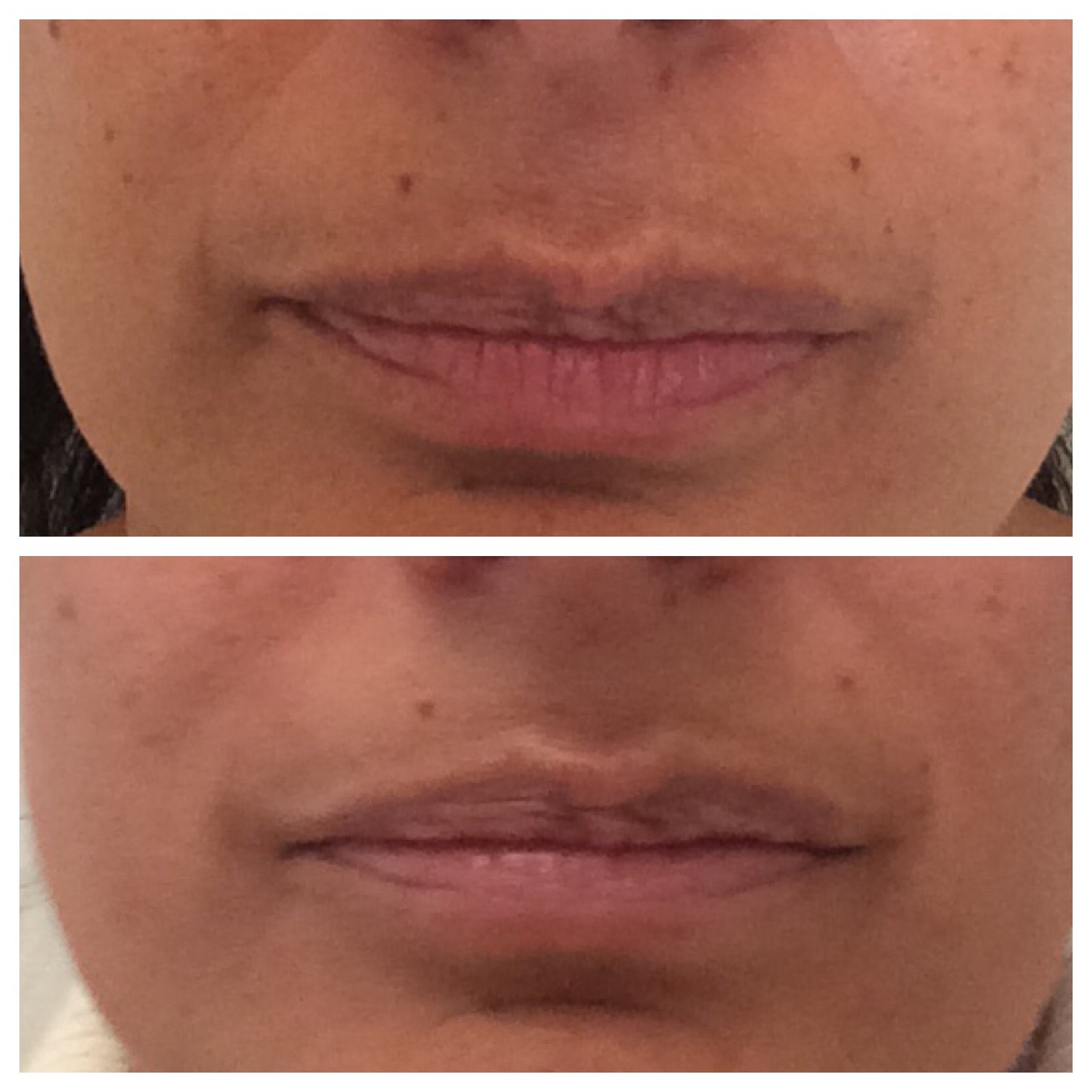 Natural Injections - Full Circle Acupuncture